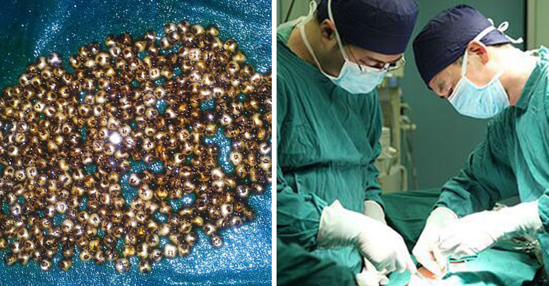 女子腹痛就醫照超音波卻看到「史上最驚人畫面」，「360顆」醫生手術夾到手麻！ | TEEPR 亮新聞